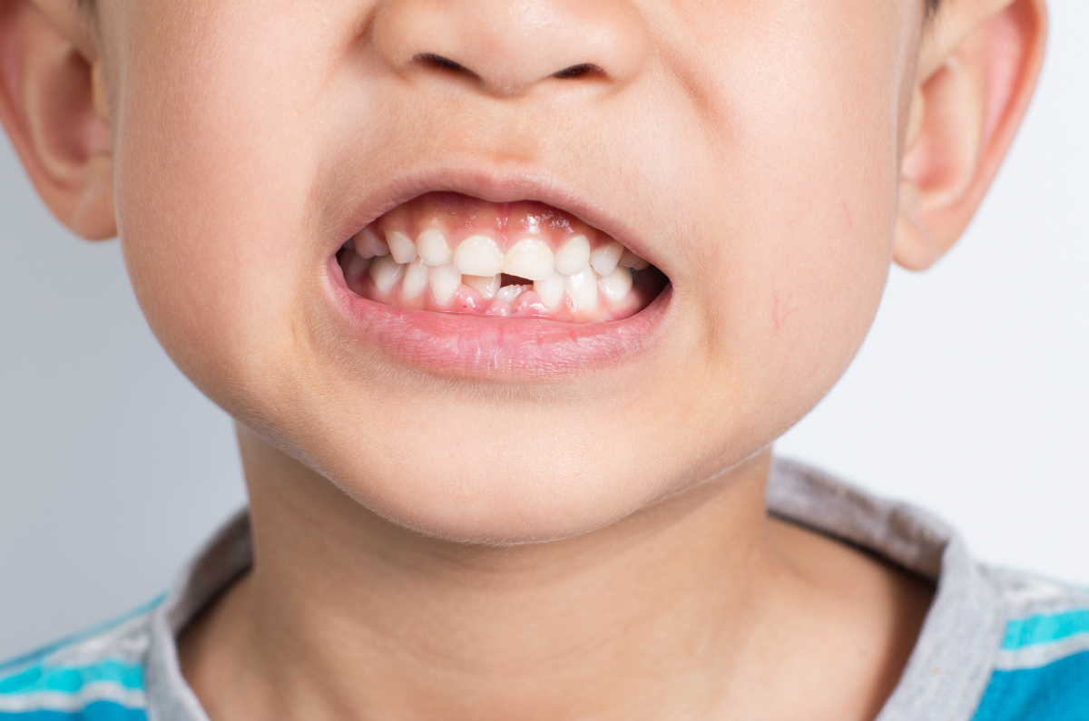 ¿Qué es la odontopediatría u odontología infantil?